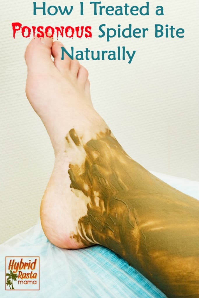 How To Treat A Spider Bite At Home | Hybrid Rasta Mama