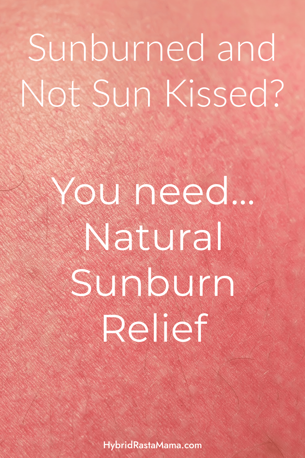 Soothe Your Sunburn Naturally: Relief Tips & Tricks | Hybrid Rasta Mama